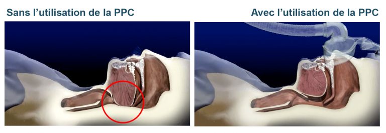 Traitement du SAOS | InnoMed
